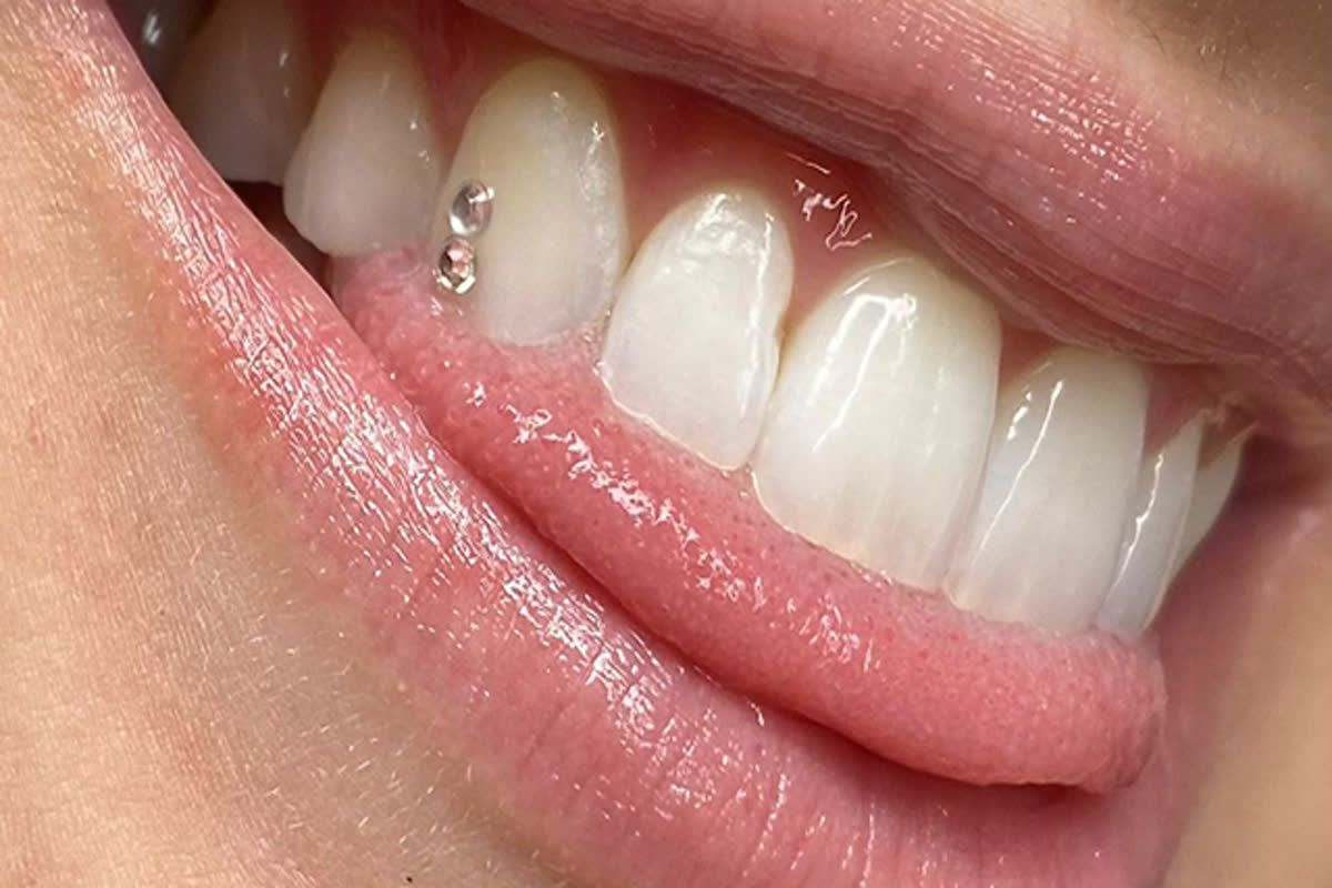 Tooth Gem, Safe or Not? Dentists Explain This Popular Gen Z Trend