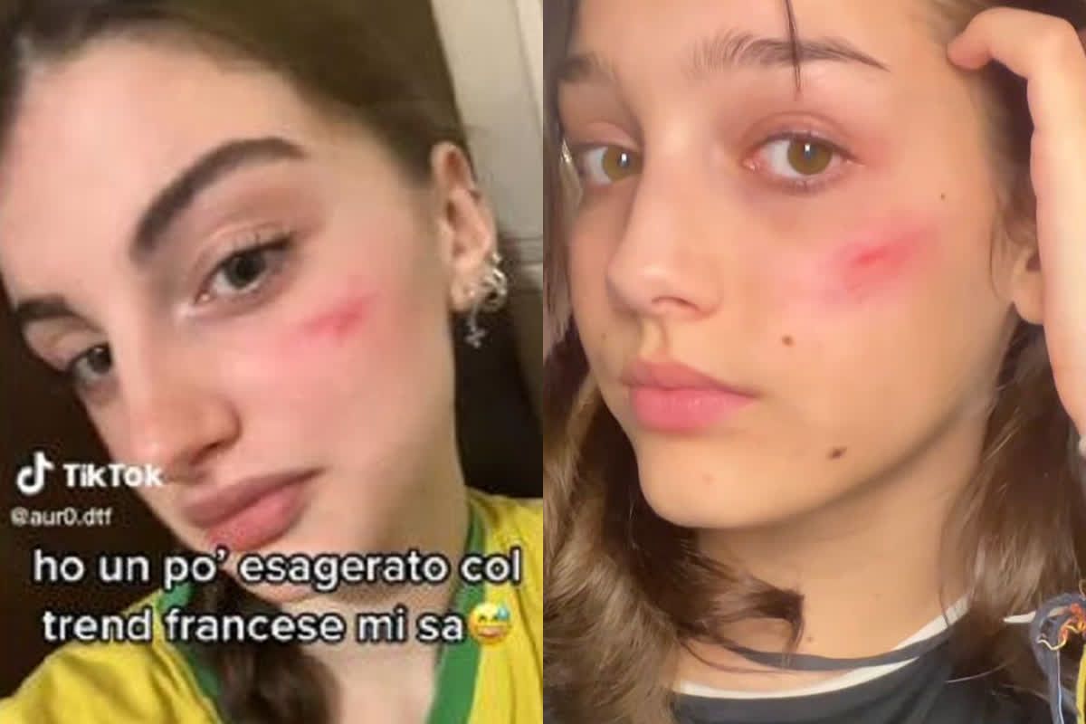 Disturbing TikTok 'Bone Smashing Challenge' Encourages Risky Self-Harm ...