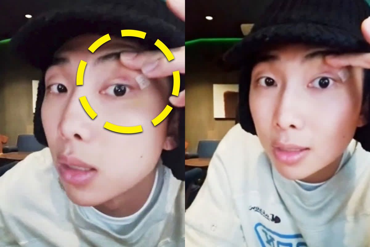 BTS Leader RM Reveals Shocking Eye Injury Details
