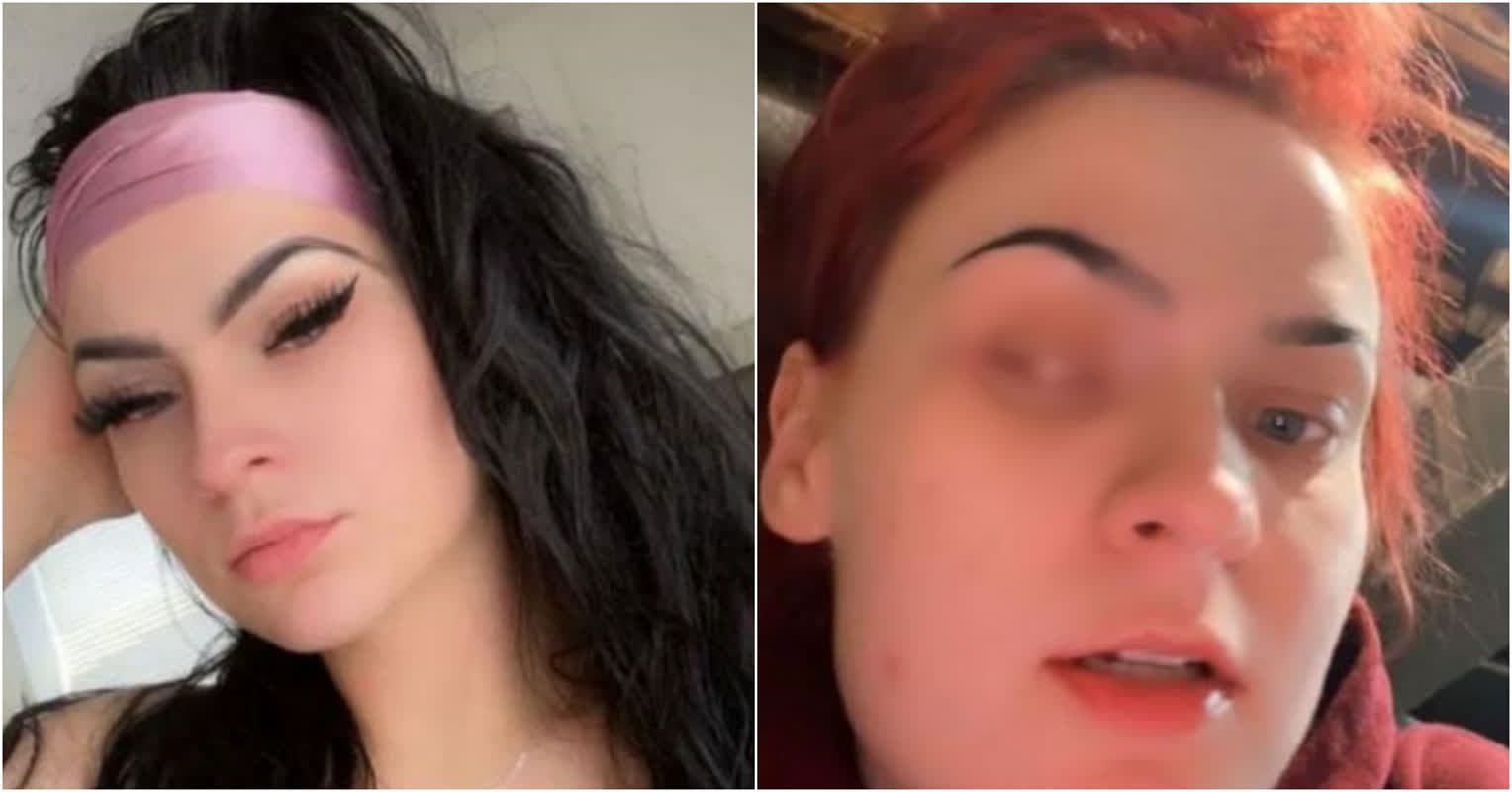 Woman Loses Eye After Fake Eyelashes Glue Causes Severe Infection