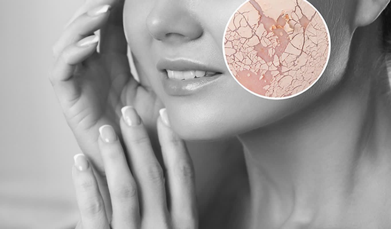Dry Skin? Here's How to Tackle Winter Skin Troubles and Stay Healthy