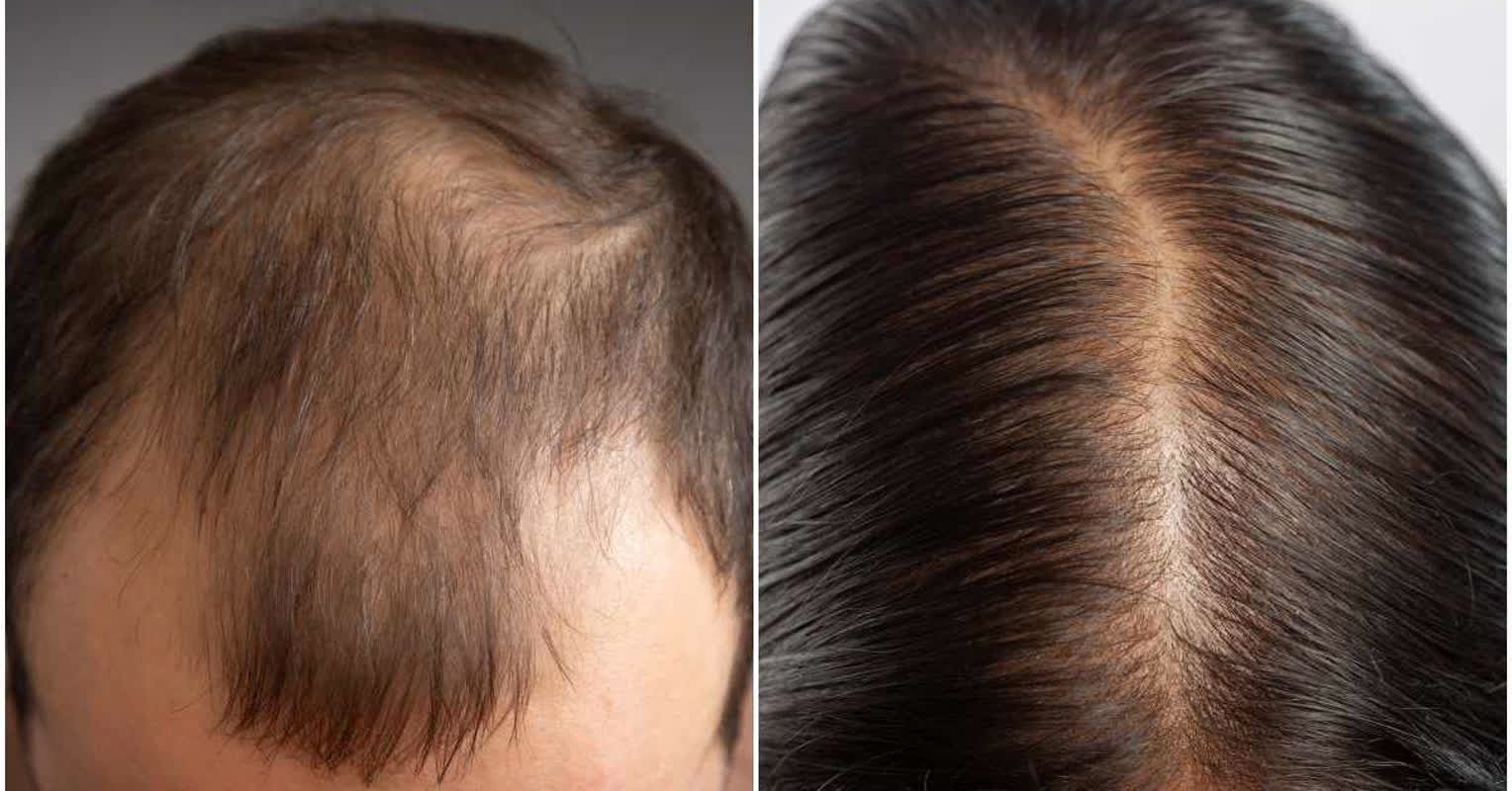 Winter Hair Loss? Avoid These 6 Habits to Keep Your Scalp Healthy