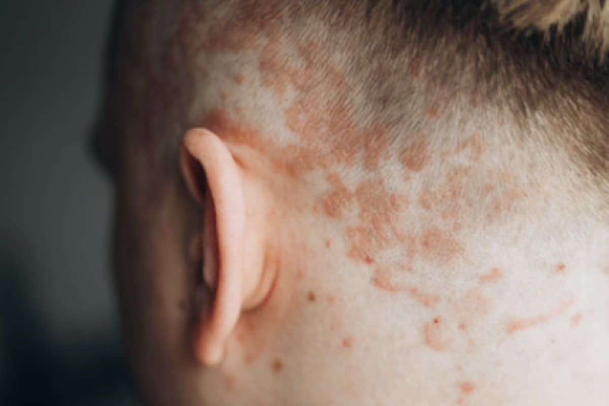New Psoriasis Foam Cuts Itch and Clears Skin, Study Says